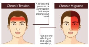 Headache Location Chart | Does Headache Location Matter?