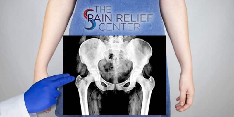 Ganglion Impar Block | The Pain Relief Center | Groin/Pelvic Pain